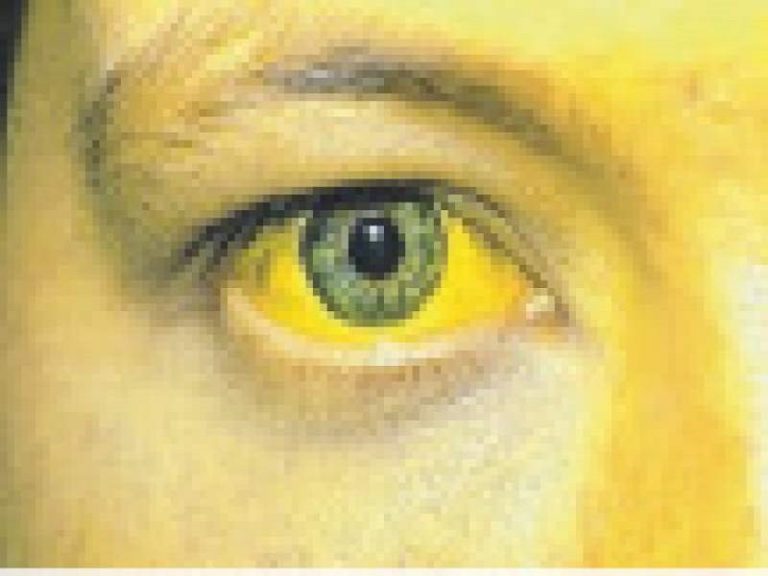 Yellow fever: symptoms, causes and treatment - Extreme Health